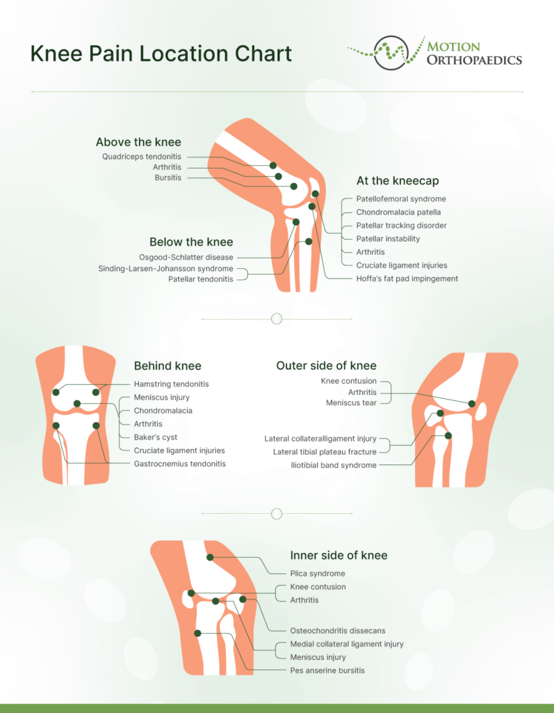 Knee Pain Location Chart | Motion Orthopaedics